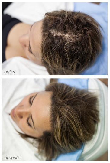 TRATAMIENTO PRP CAPILAR - Dra. María Amaro